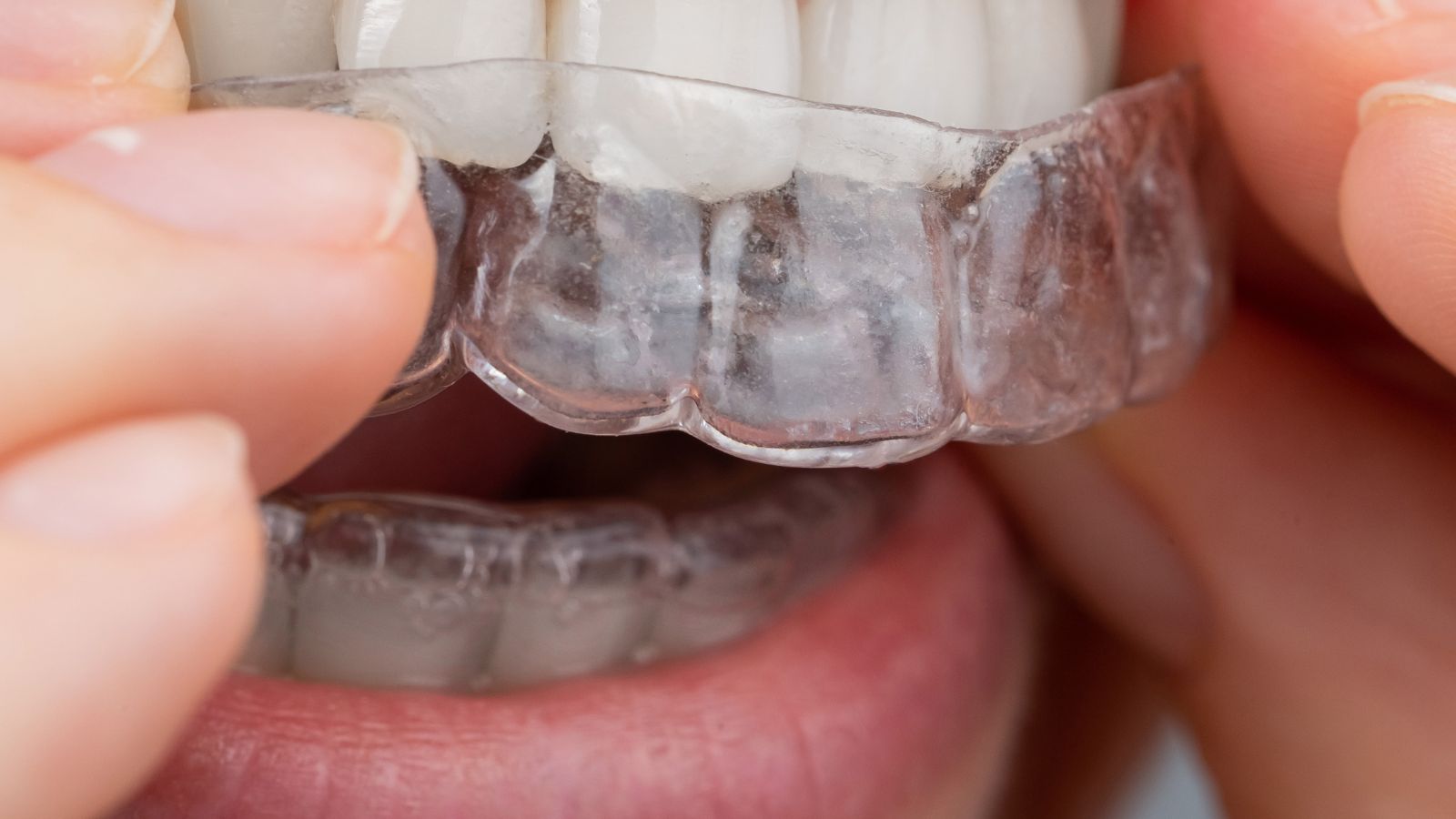 Teeth Straightening Myths: 5 Common Misconceptions Debunked - Netcurtains